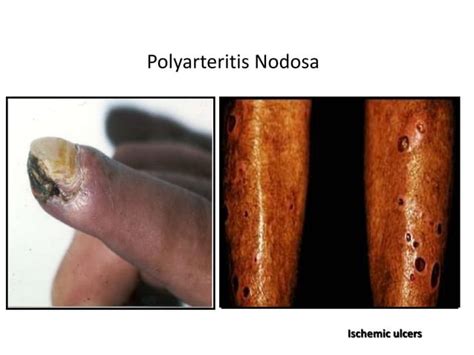 Polyarteritis Nodosa Pptx Polyarteritis Nodosa Pptx