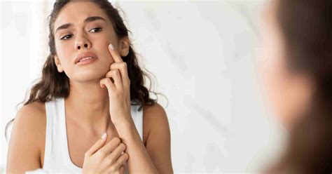 Cheek Acne Causes And Ways To Reduce Them