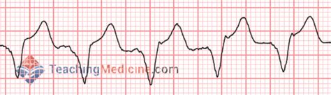 Wide QRS