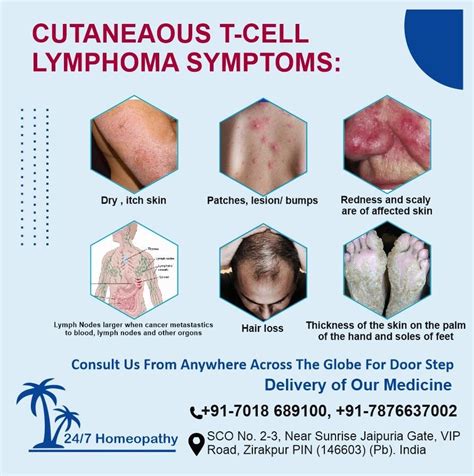 Cutaneaous T Cell Lymphoma 247homeopathy