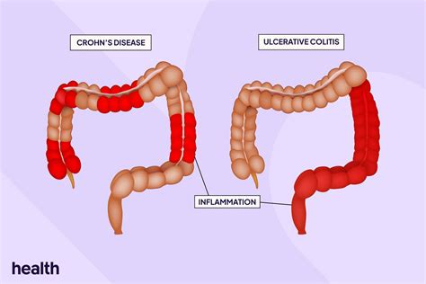 Crohns And Colitis Similarities And Differences