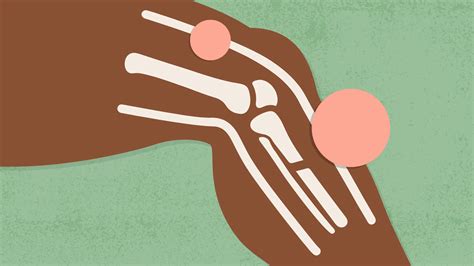 What Is Rheumatoid Factor A Complete Guide