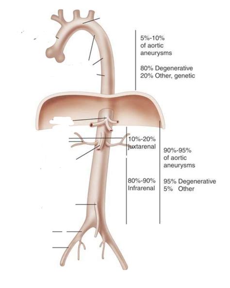 Locations Of Aneurysms Diagram Quizlet