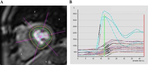 Semi Quantitative Perfusion Analysis Semi Quantitative Perfusion