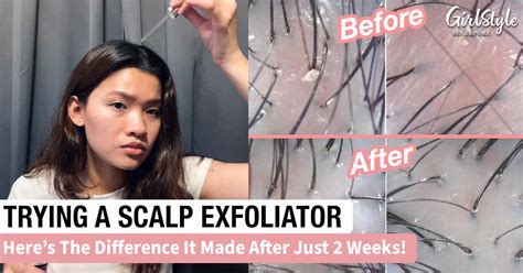 I Did A Scalp Exfoliation Treatment For 2 Weeks And Heres How It Improved My Scalp Health