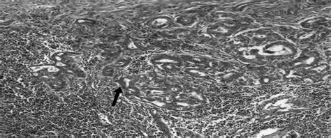 Thyroid Remnant Radioiodine Ablation In A Case Of Concurrent