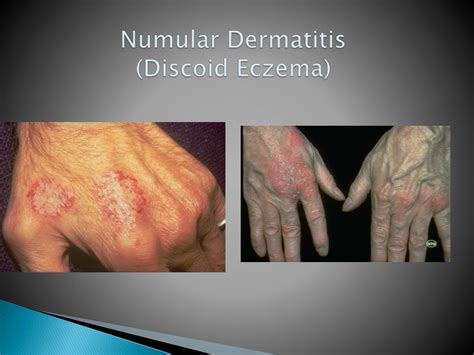 Ppt Eczema And Dermatitis Powerpoint Presentation Free Download Id