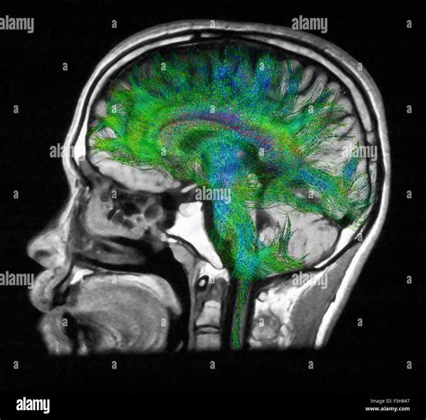 Diffusion Mri Also Referred To As Diffusion Tensor Imaging Or Dti Of The Human Brain Stock