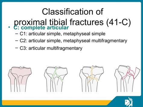 Proximal Tibial Fracture Ppt