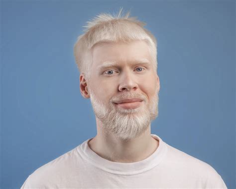 Albinism Signs Causes Types Optimists Wellness India