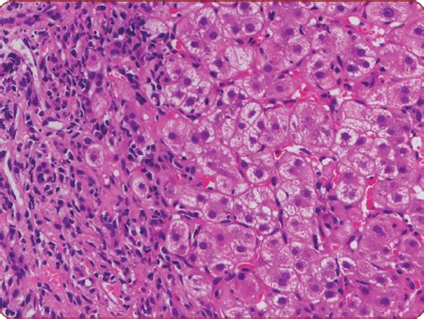 Liver Biopsy Showing Interface Hepatitis With Predominant Lymphocytic