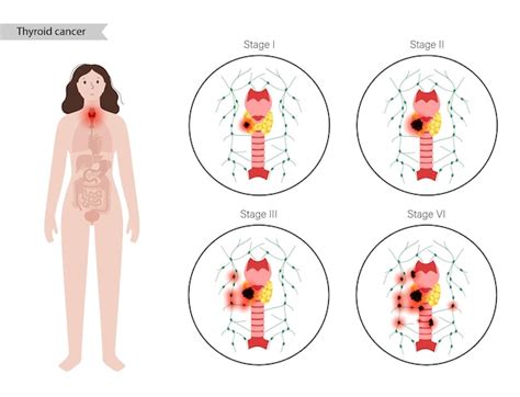 Premium Vector Thyroid Cancer Stages
