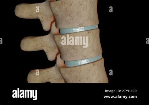 Fracture Of Vertebra Stock Videos And Footage Hd And 4k Video Clips Alamy