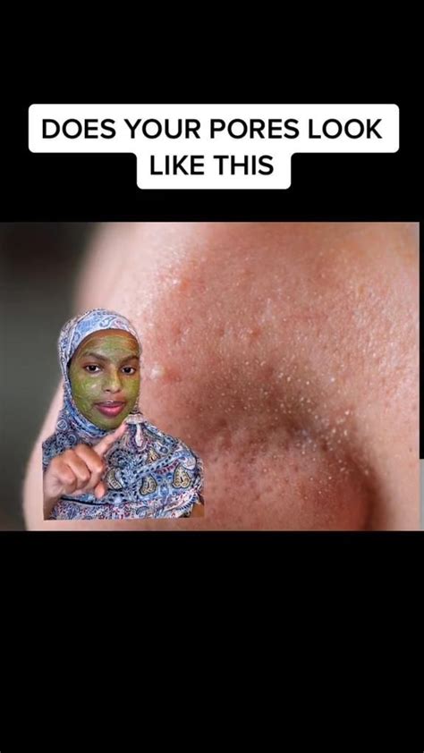 How To Get Rid Of Clogged Pores Artofit