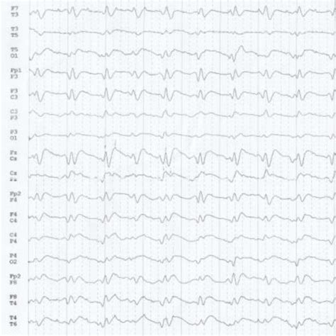 New Eeg Showed Periodic Sharp Wave Complexes Pswc Suggesting Cjd Download Scientific Diagram