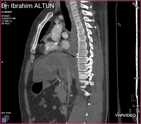 Ibrahim Altun On Linkedin A Case From My Archive Aortic Transection Grade 3 A Patient With…