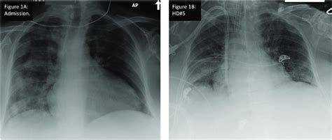 A Chest X Ray On Admission Demonstrates Focal Right Sided Infiltrates