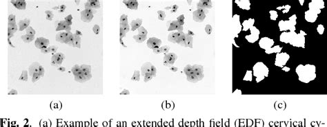 figure 1 from patch based segmentation of overlapping cervical cells
