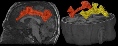 Superior Longitudinal Fasciculus Slf Illustrated With Deterministic Download Scientific