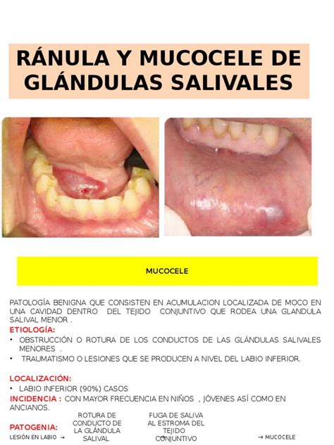 Ranula Y Mucocele Pdf