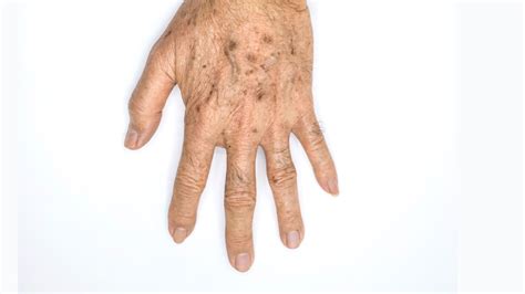 Sun Spots Vs Skin Cancer And How To Tell The Difference