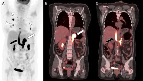 18f Fdg Petct Of Malignant Angiomyolipoma With Tumor Thromb