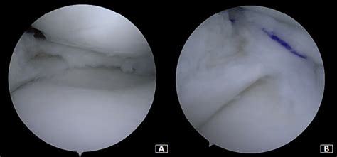 Arthroscopic View Of The Final C Shape Of The Meniscus After
