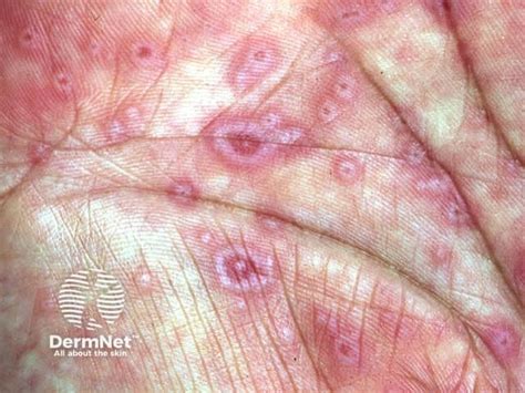 Bullous Erythema Multiforme