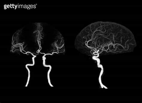 Ct Angiography Of The Brain Or Cta Brain Showing Cerebral Aryery 1491186258 게티이미지뱅크