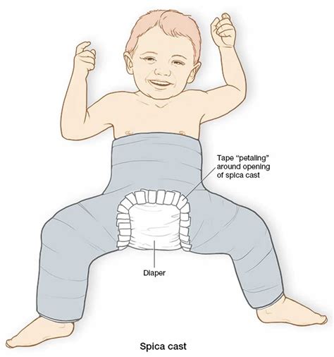 What Is The Spica Cast Used For At Leo Stonham Blog