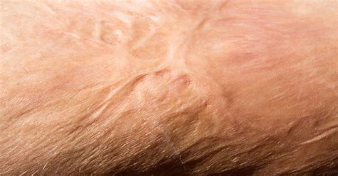 Рубец кожи Большая российская энциклопедия