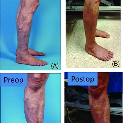 Post Radiofrequency Thermal Ablation And Multiple Foam Sclerotherapy