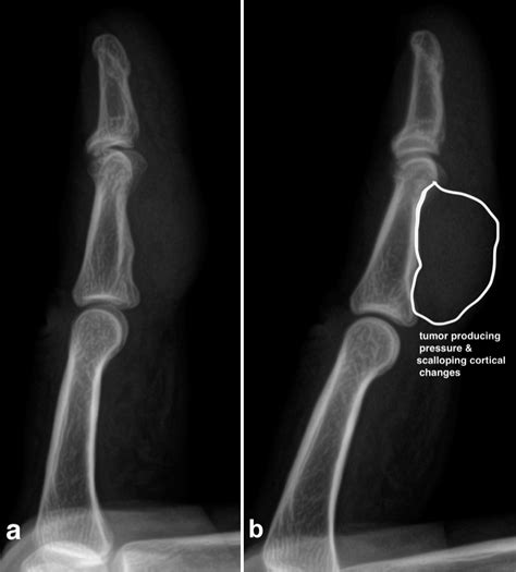 Giant Cell Tumor Of The Tendon Sheath A Critical Review Of Current