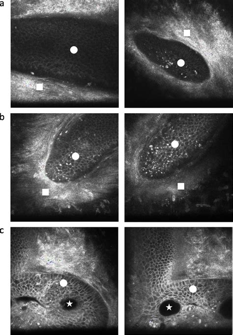 Confocal Microscopy At Initial Presentation A Right Eye Corneal