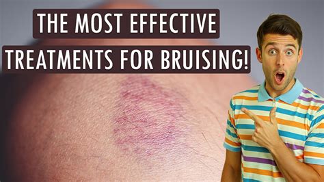 The Most Effective Treatments For Bruising