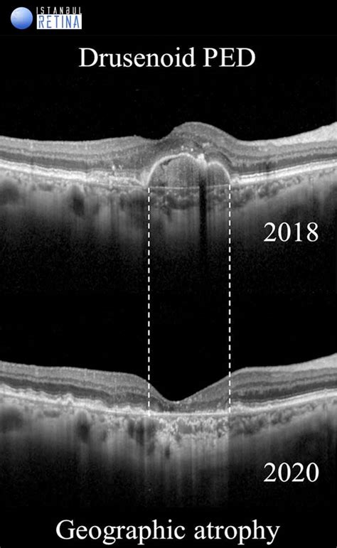 Age Related Macular Degeneration Oct Club