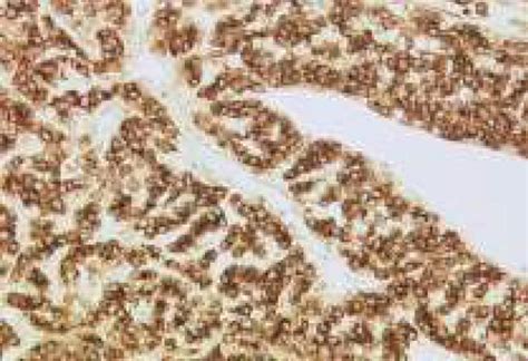 A Metastasis Of Epithelioid Gist In The Right Atrium Of The Heart Download Scientific Diagram
