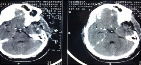 Post Op Ct Brain Showing Complete Excision Download Scientific Diagram