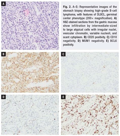 Large B Cell Lymphoma With Irf4 Rearrangement Of Retroperitoneal Lymph