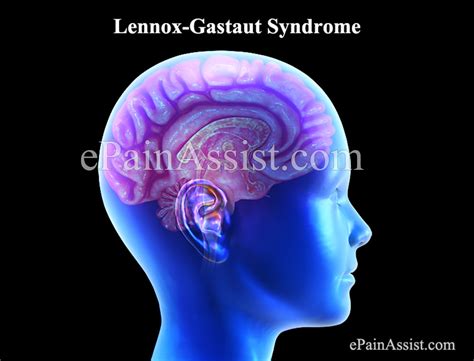 Lennox Gastaut Syndrome Treatment Life Expectancy Prognosis Causes Symptoms