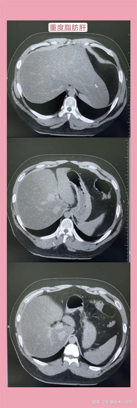 脂肪肝ct（多种表现） 知乎