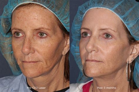 Co2 Laser Resurfacing Laser Skin Rejuvenation Cosmetic Laser Dermatology