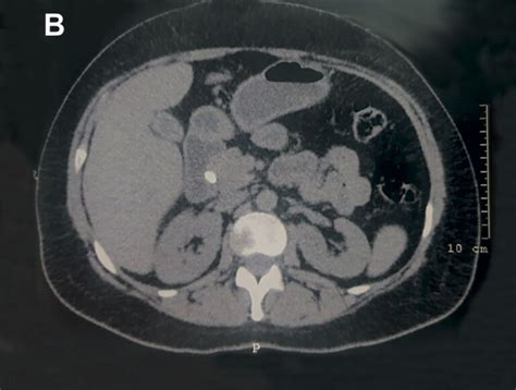 Mirizzi Syndrome Mimicking Cholangiocarcinoma Case Report