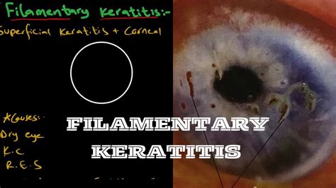 Filamentary Keratitis Ophthalmology Youtube