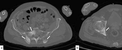 Osteolytic Or Mixed Bone Metastasis Is Not Uncommon In Patients With