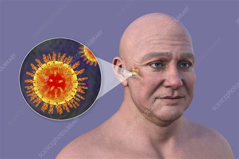 Otitis Media In A Man Illustration Stock Image F0435509 Science