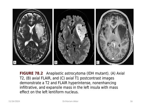Diseases Of Brain Tumer Classification Of Brain Tumor Ppt