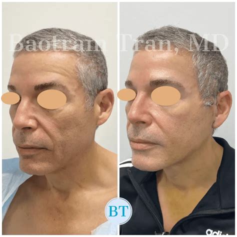 Mini Facelift Archives Tran Plastic Surgery