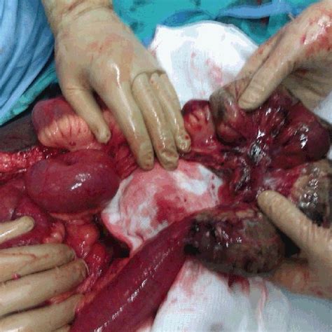 Large Mesenteric Defect With Devascularized Small Bowel Download