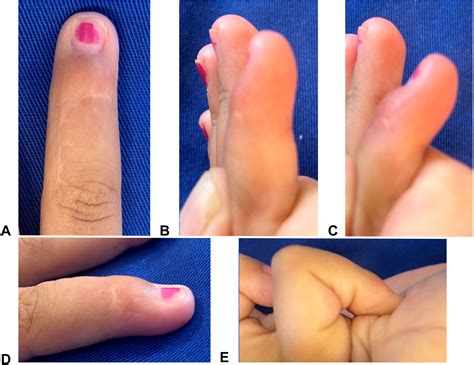 Congenital Mallet Finger A Case Report Journal Of Hand Surgery